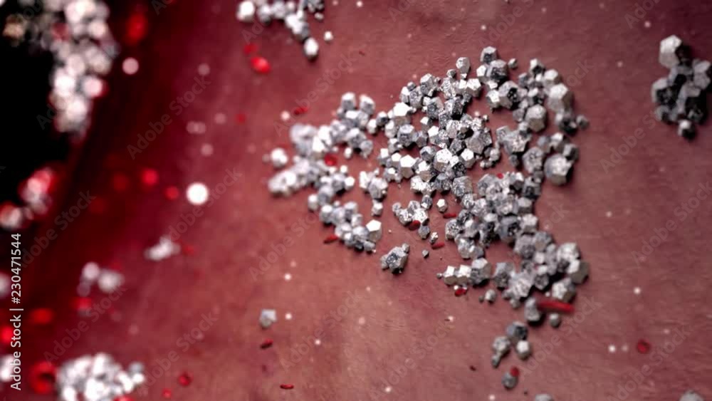 The formation of stones or deposits on the walls of blood vessels in ...