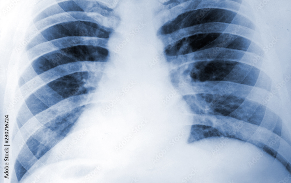 X Ray or Fluorogram of Human Thorax - Medical Tuberculosis Diagnostic ...