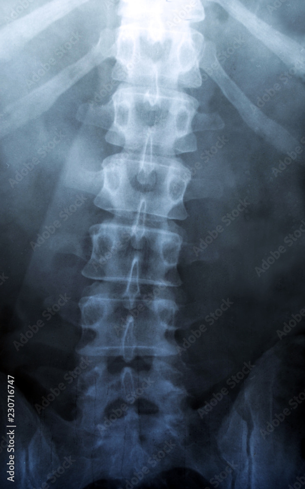 X Ray of Backbone - Human Skeleton Medical Scoliosis or Osteochondrosis ...