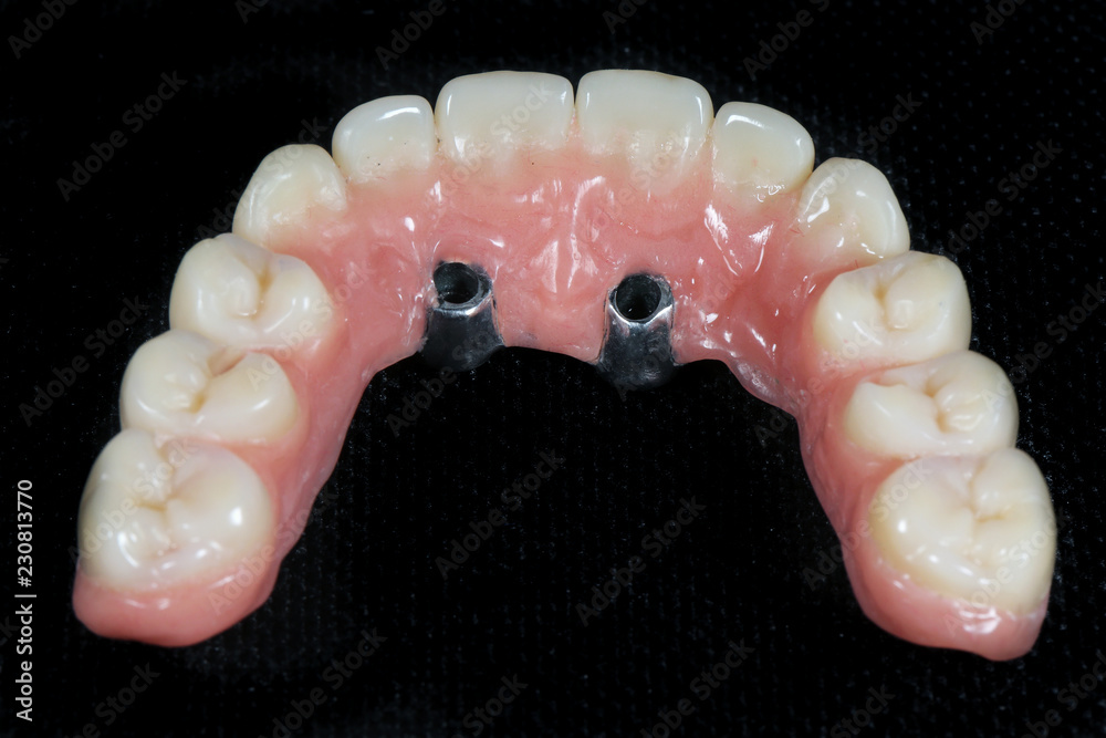 Made ceramicite prosthesis with a titanium beam, top view Stock Photo ...