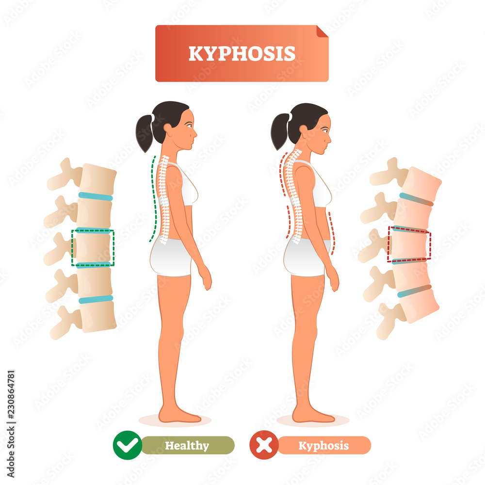 Kyphosis vector illustration. Back spine defect diagnosis vs healthy ...