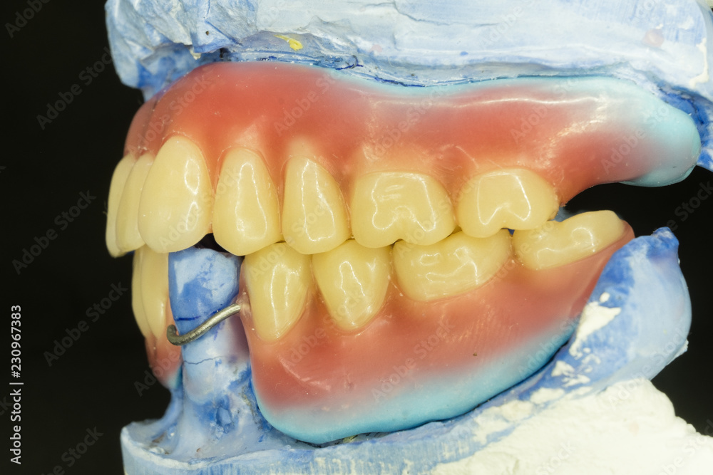 artificial teeth arrangement of removable denture Stock Photo | Adobe Stock