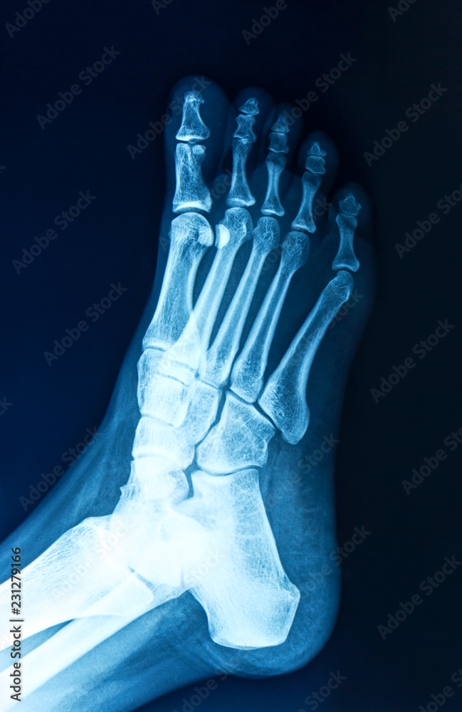 Film x-ray normal human's foot lateral Stock Photo | Adobe Stock