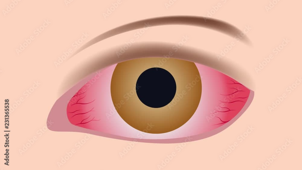 Conjunctivitis. pink and red inflammation eye graphic animation Stock ...