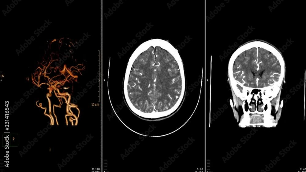 computed tomography angiography, CTA of the brain, 3D Rendering image ...