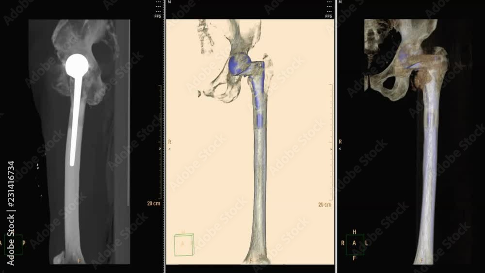 CT SCAN image of pelvic bone / Hip bone 3D rendering image with Total ...