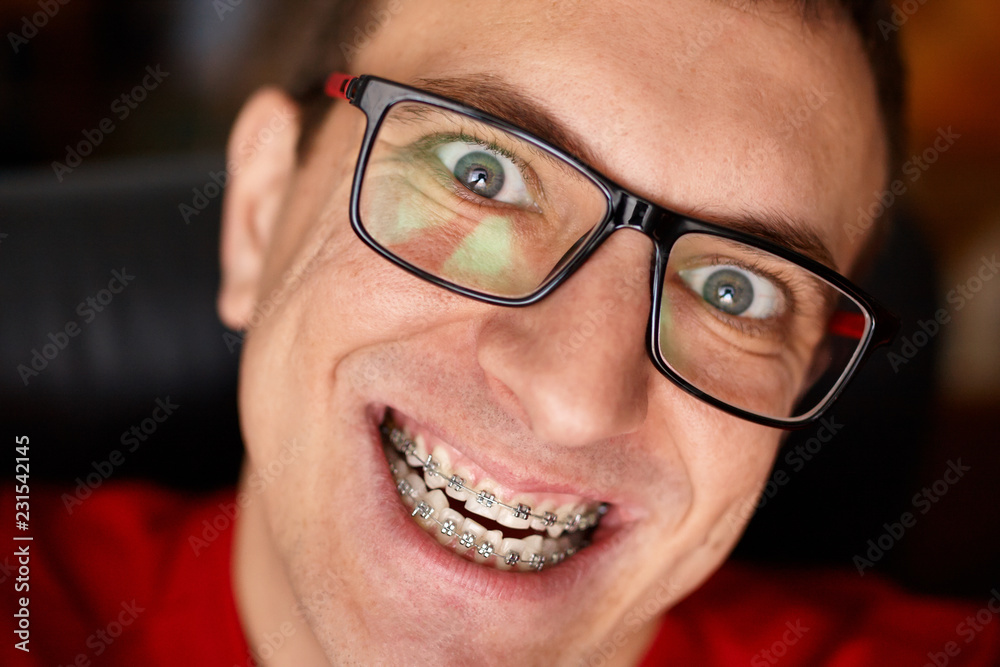 Curved teeth of guy with braces in glasses close up. Portrait of man ...