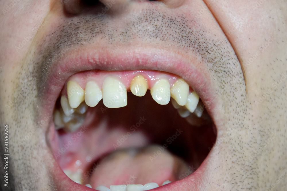 The process of replacing a tooth. Preparation of the tooth under the ...