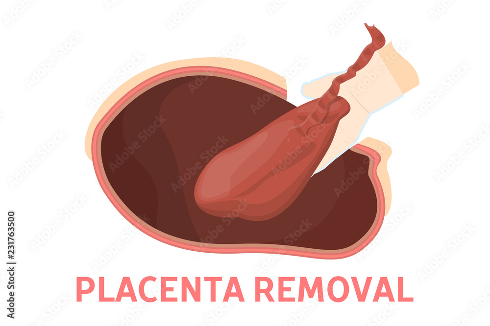 Placenta removal stage of birth via cesarean section Stock Vector ...