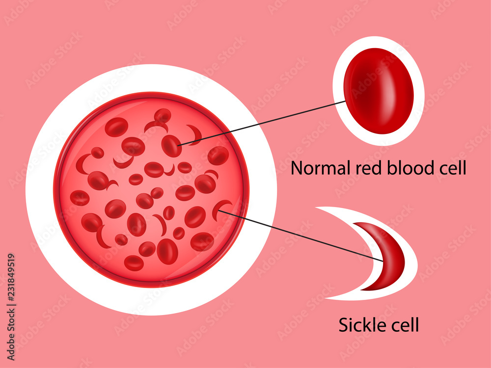 Difference of normal red blood cells and sickle cells Stock Vector ...