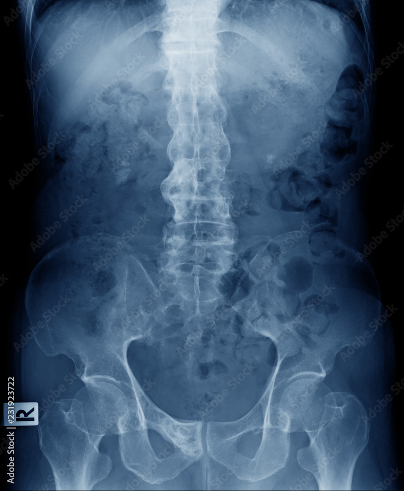 x-ray image of old man show ankylosing spondylitis or bamboo spine ...