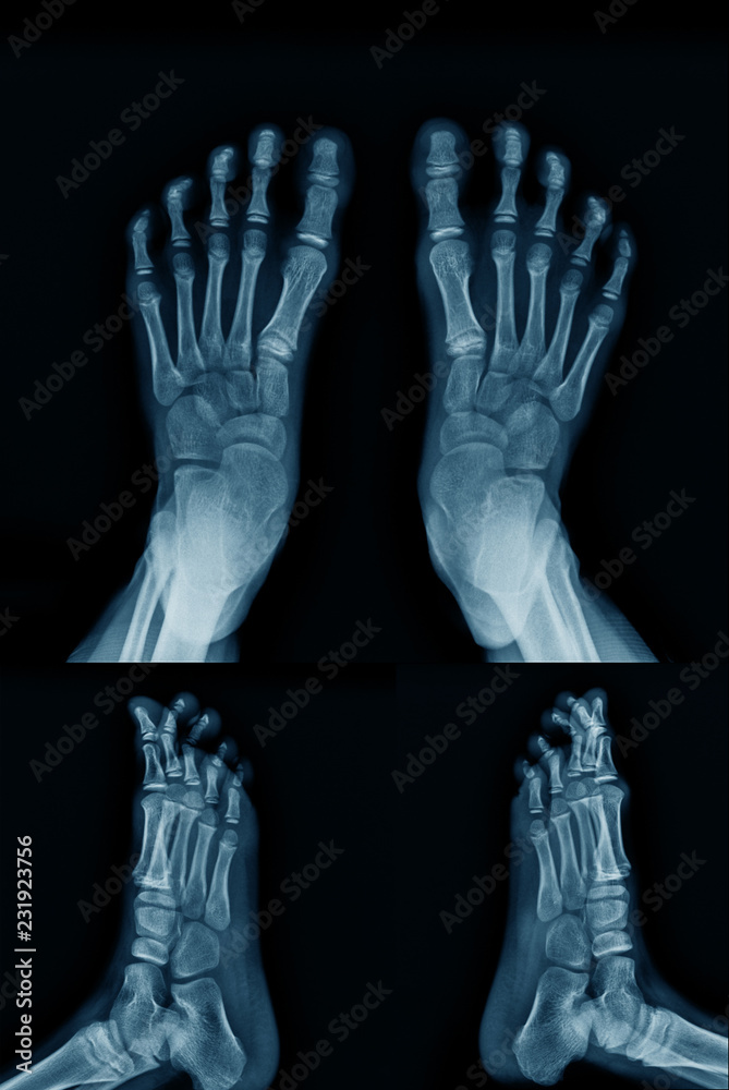 x-ray foot both side with lateral view both side Stock Photo | Adobe Stock