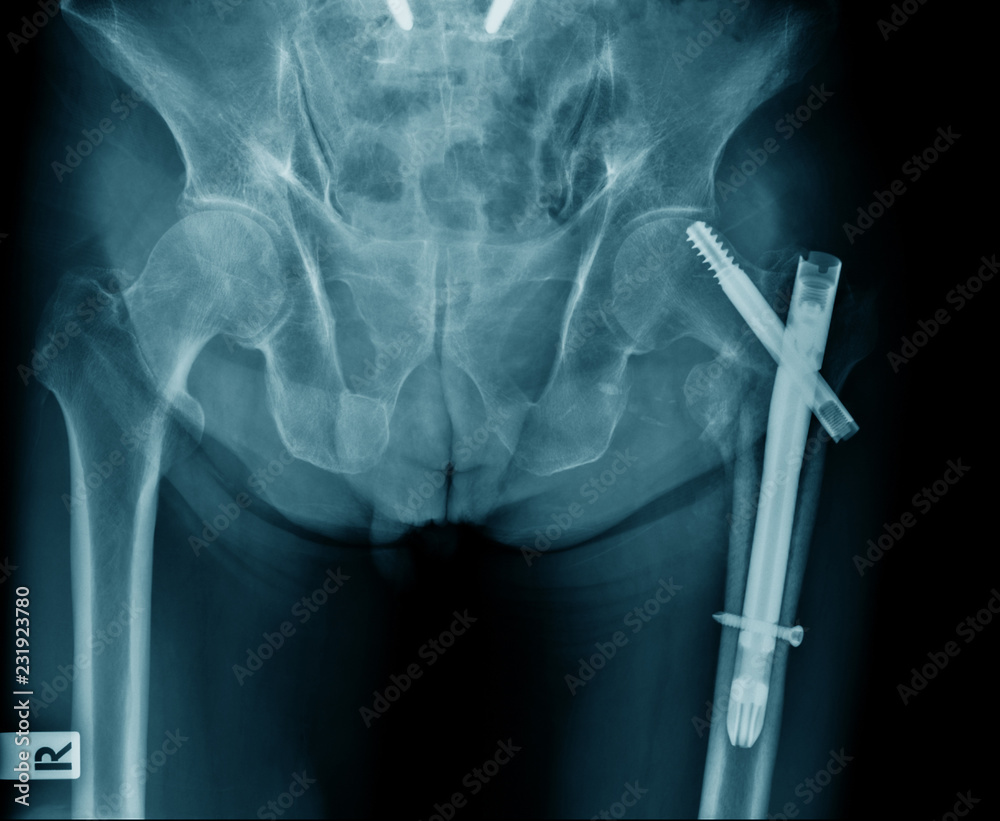 hip fixation for old patient with hip fracture Stock Photo | Adobe Stock