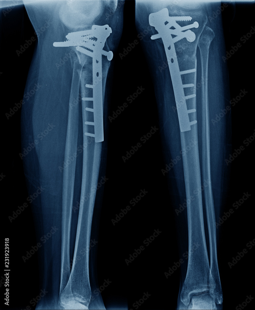 x-ray image of leg show tibia bone fixation Stock Photo | Adobe Stock