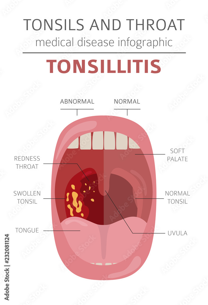 Tonsils and throat diseases. Tonsillitis symptoms, treatment icon set ...