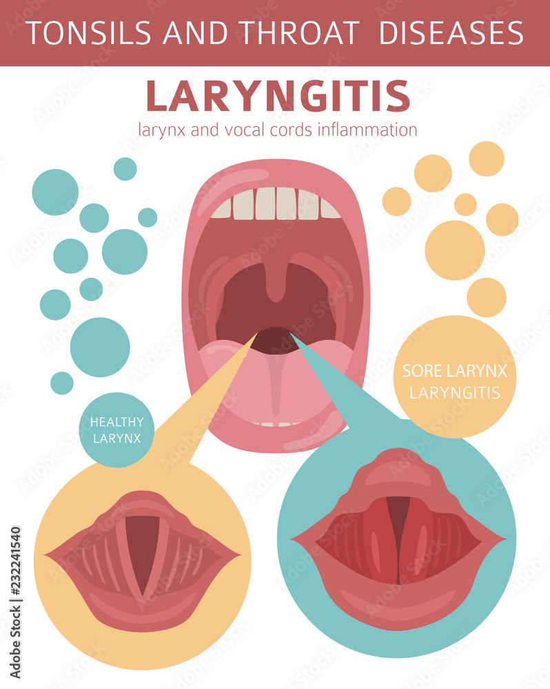 Tonsils and throat diseases. Laryngitis symptoms, treatment icon set ...