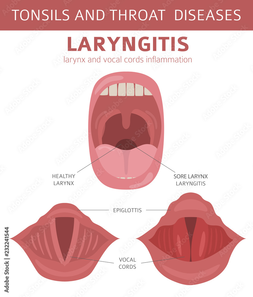 Tonsils and throat diseases. Laryngitis symptoms, treatment icon set ...
