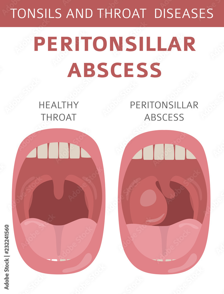 Tonsils and throat diseases. Peritonsillar abscess symptoms, treatment ...