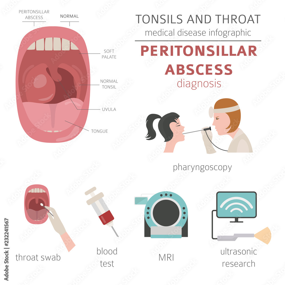 Tonsils and throat diseases. Peritonsillar abscess symptoms, treatment ...