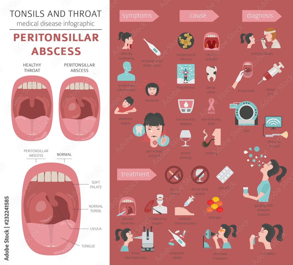 Vetor de Tonsils and throat diseases. Peritonsillar abscess symptoms ...