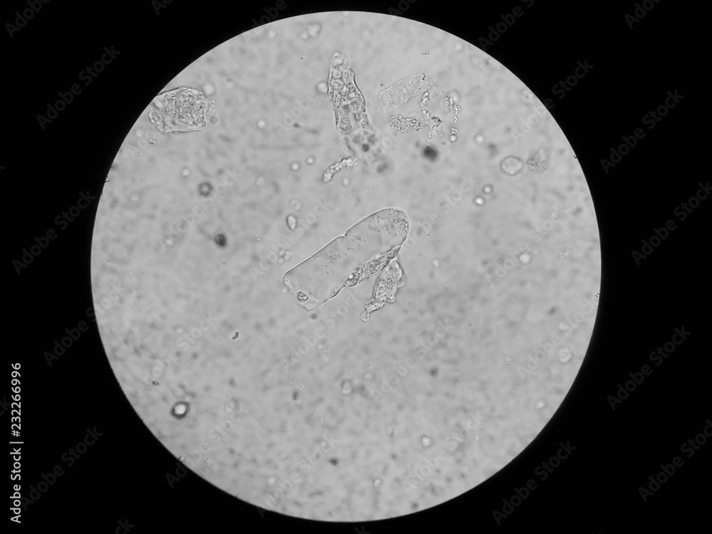 Significance Cast of Urinary under 40X light microscope, Waxy cast ...