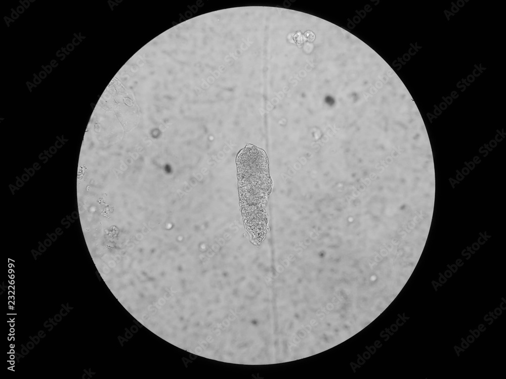 Significance Cast of Urinary under 40X light microscope, Waxy cast ...