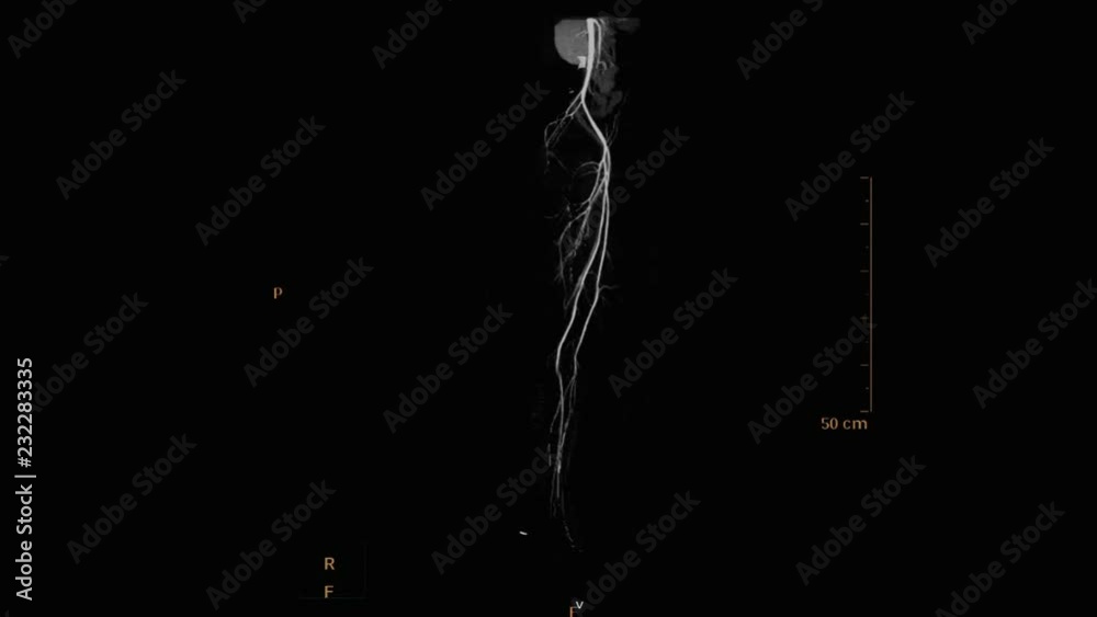 computed tomography angiography, CTA of lower extremity , CTA femoral ...