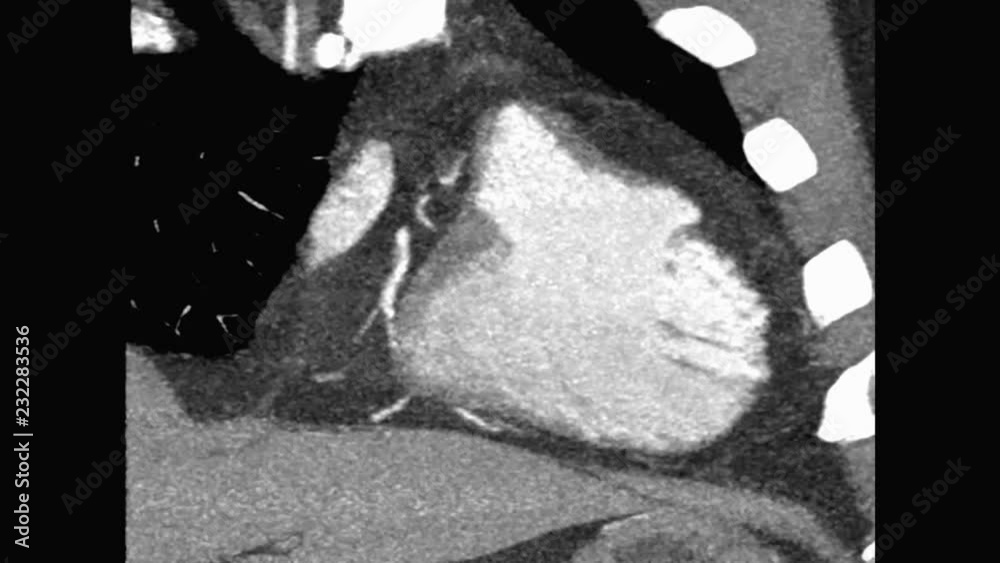 Coronary CT Angiography , computed tomography angiography ( CTA ...