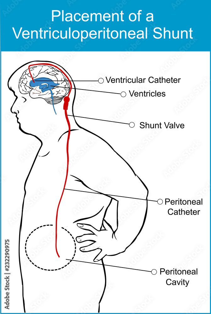 Poster Vector illustration of a placement of a Ventriculoperitoneal ...