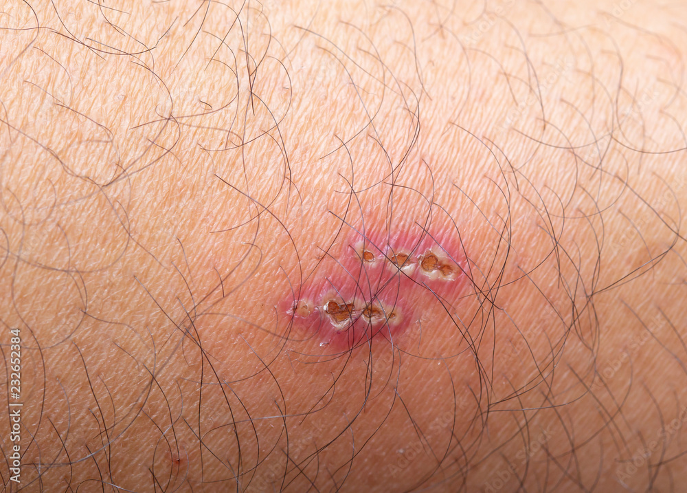 Wound infection on the skin, Skin lesions, Impetigo, Ecthyma Stock ...