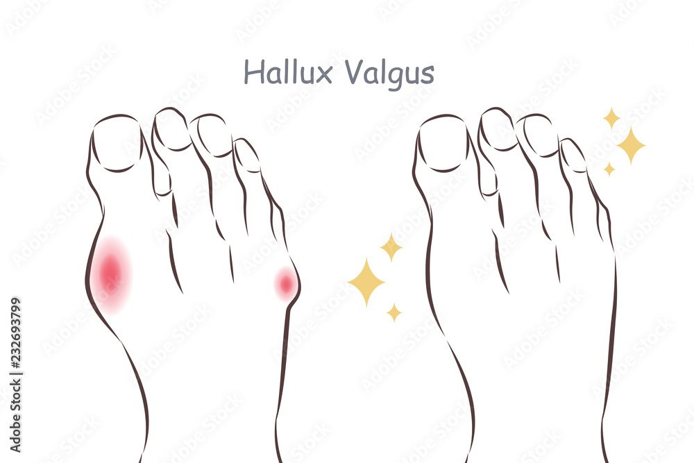 normal foot and hallux valgus Stock Vector | Adobe Stock