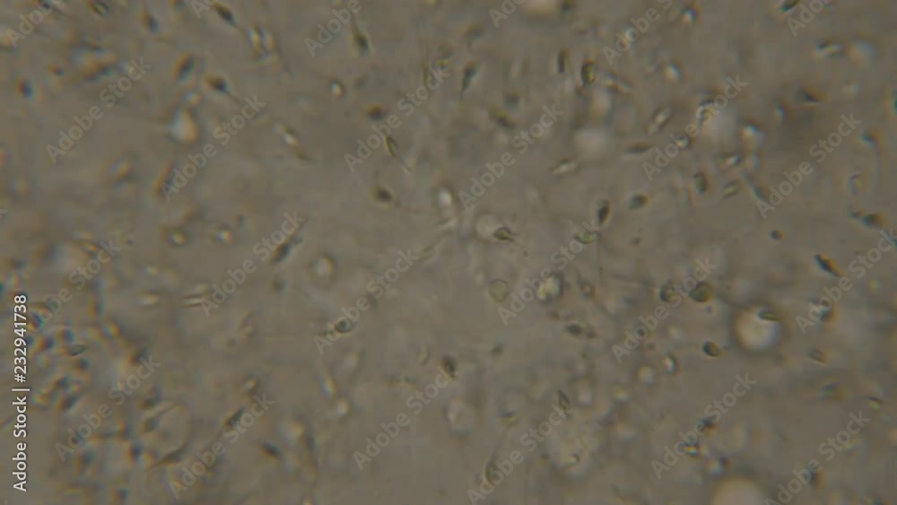 Sperm Spermatozoa Viewed Under The Microscope Moving Human Sperm