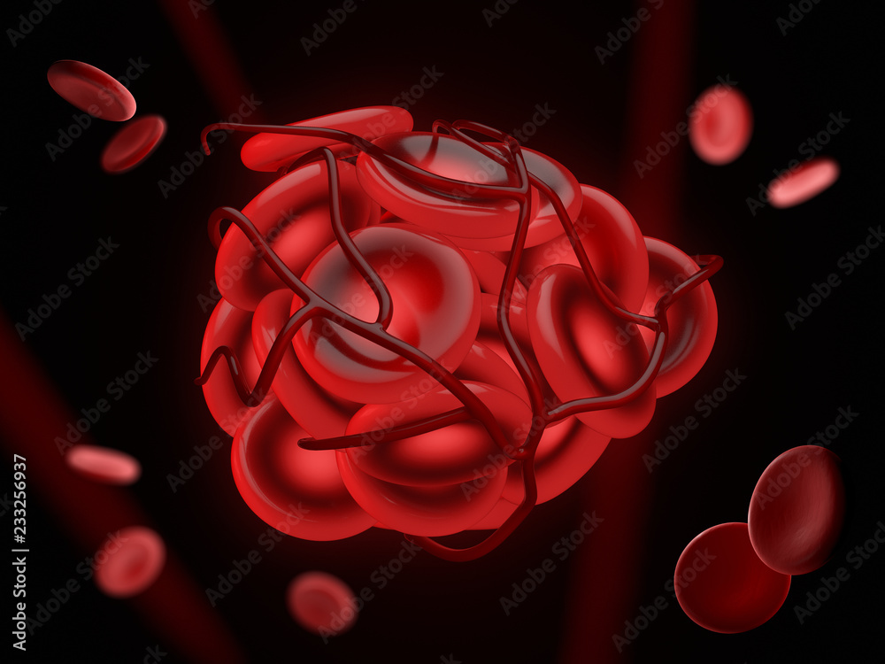 3d Illustration of illustration of a blood clot, thrombus or embolus ...
