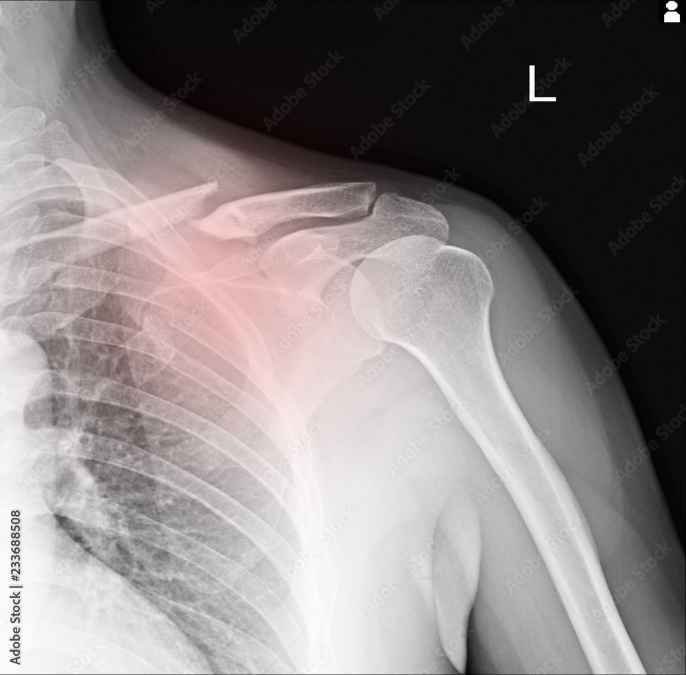 Chest x-ray Fractures left clavicle, anterior 2nd rib, posterior rib 4 ...