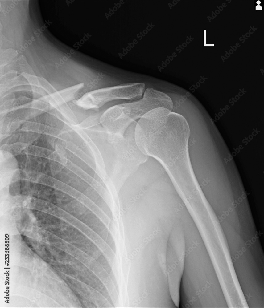 Chest x-ray Fractures left clavicle, anterior 2nd rib, posterior rib 4 ...