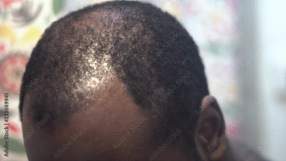 african american black male has signs of receding hairline and male ...