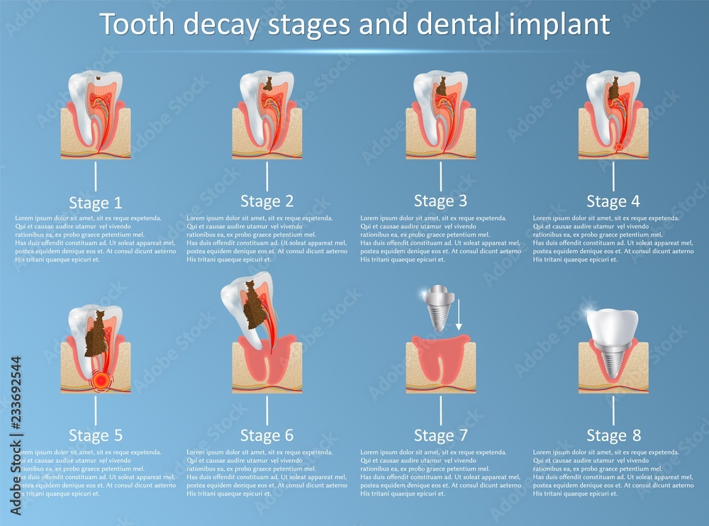 Tooth Decay Process