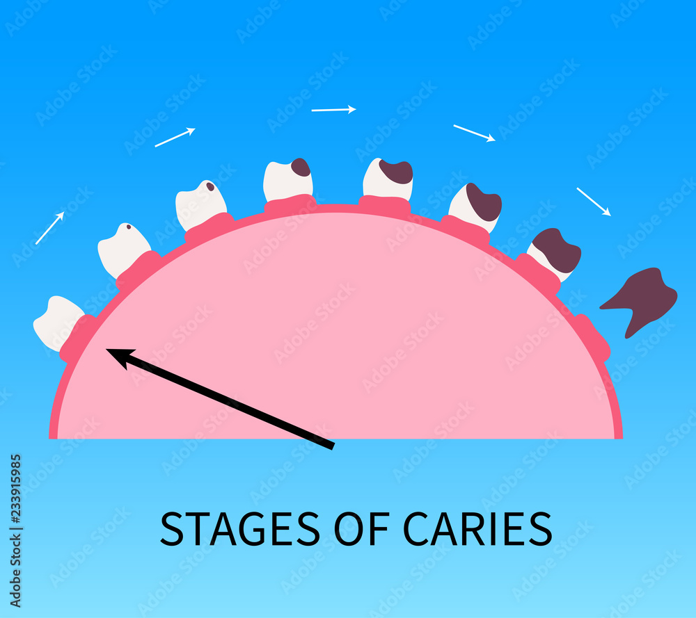 stages of caries development. vector Stock Vector | Adobe Stock