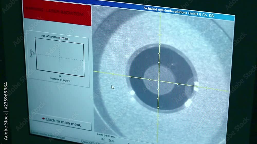 cataract surgery on monitor, Surgeon operating eye cataract in hospital ...