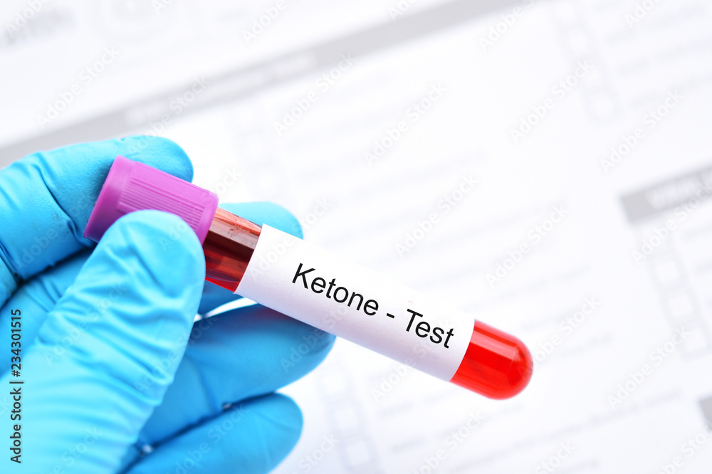 Blood sample tube for ketone test, diagnosis for diabetic ketoacidosis ...