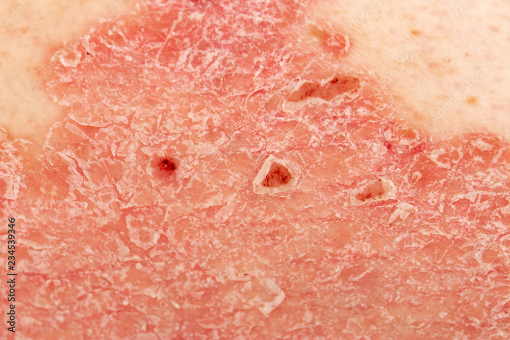 Psoriasis Vulgaris - detail of psoriatic skin disease, an autoimmune ...