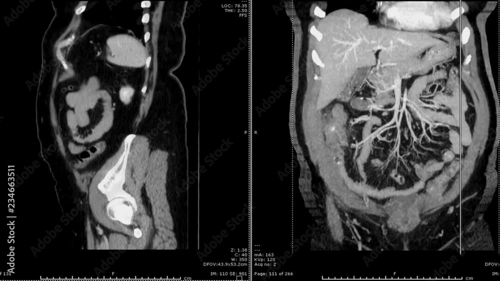 CT scan / CT whole abdomen sagittal vs coronal view . medical ...