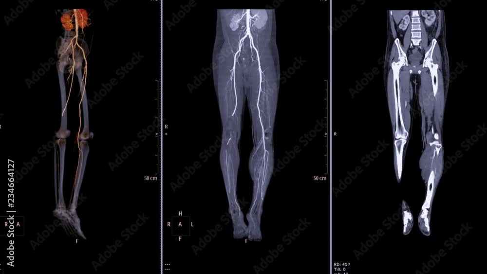 computed tomography angiography, CTA of lower extremity , CTA femoral ...