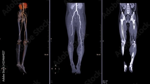 computed tomography angiography, CTA of lower extremity , CTA femoral ...
