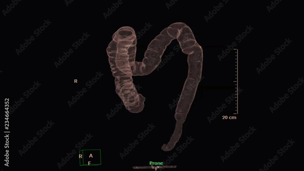 CT colonography or CT Scan of Colon 3D rendering image Rotating on the ...