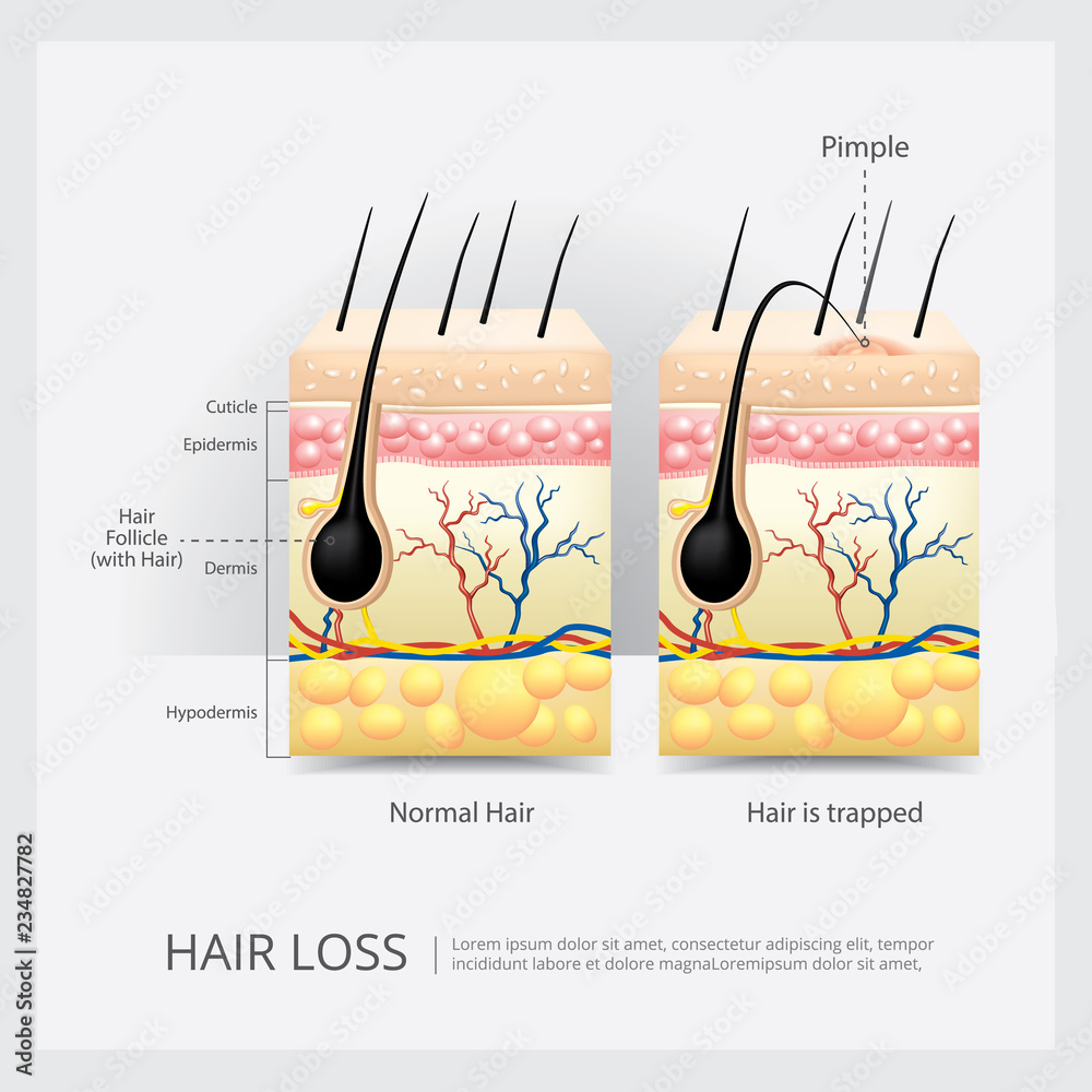 Ingrown Hair Structure Vector Illustration Stock Vector | Adobe Stock