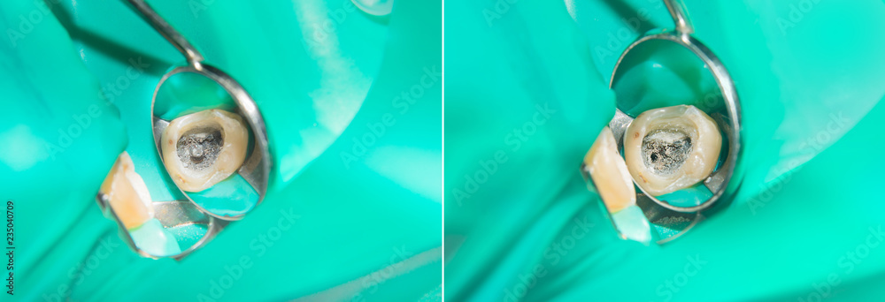 Teeth during treatment close-up in a dental clinic. Dental photopolymer ...