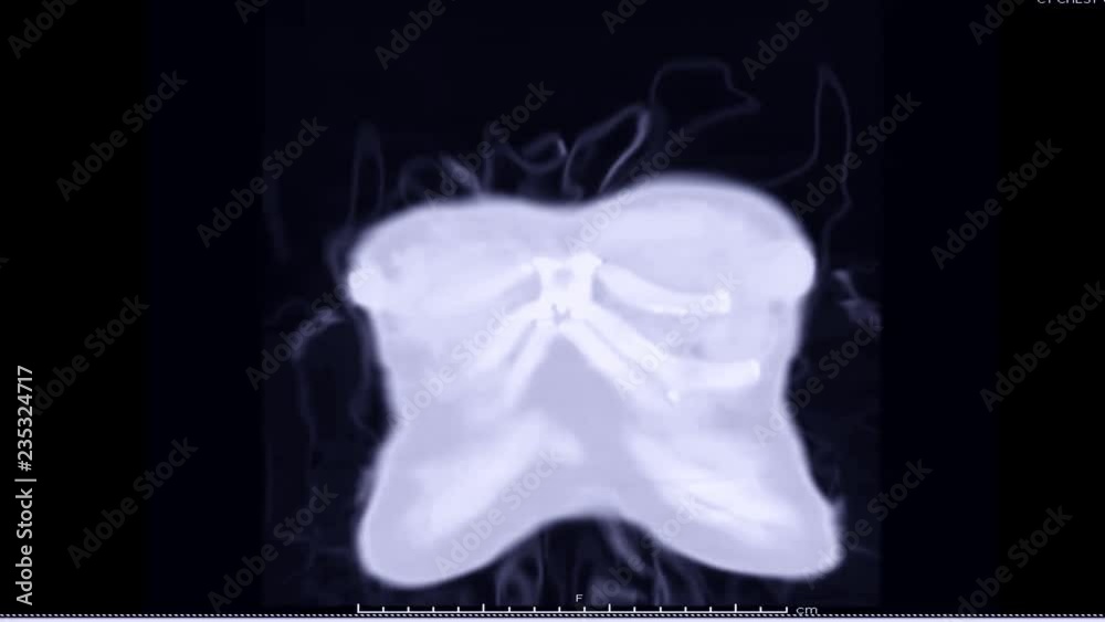 Computed Tomography (CT) Scans of the human Chest or CT lung Coronal ...