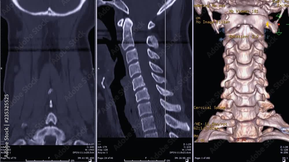 CT SCAN of Cervical Spine ( C-spine ) patient trauma case coronal plane ...
