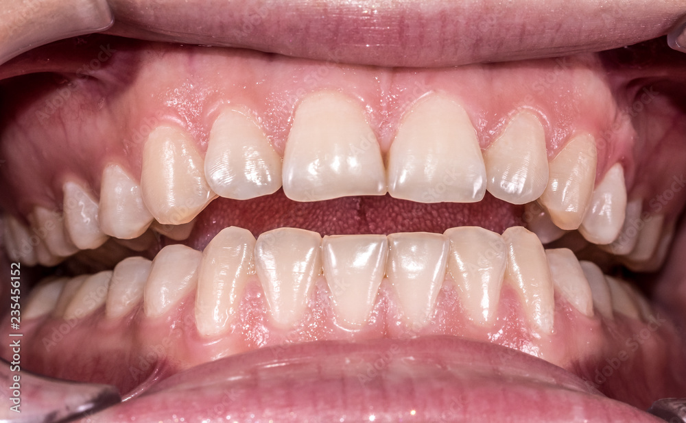 Healthy human teeth with normal occlusion from frontal view Stock Photo ...